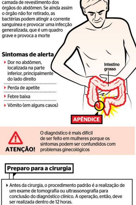 Apendicite: o que é, sintomas e causas - Minha Vida